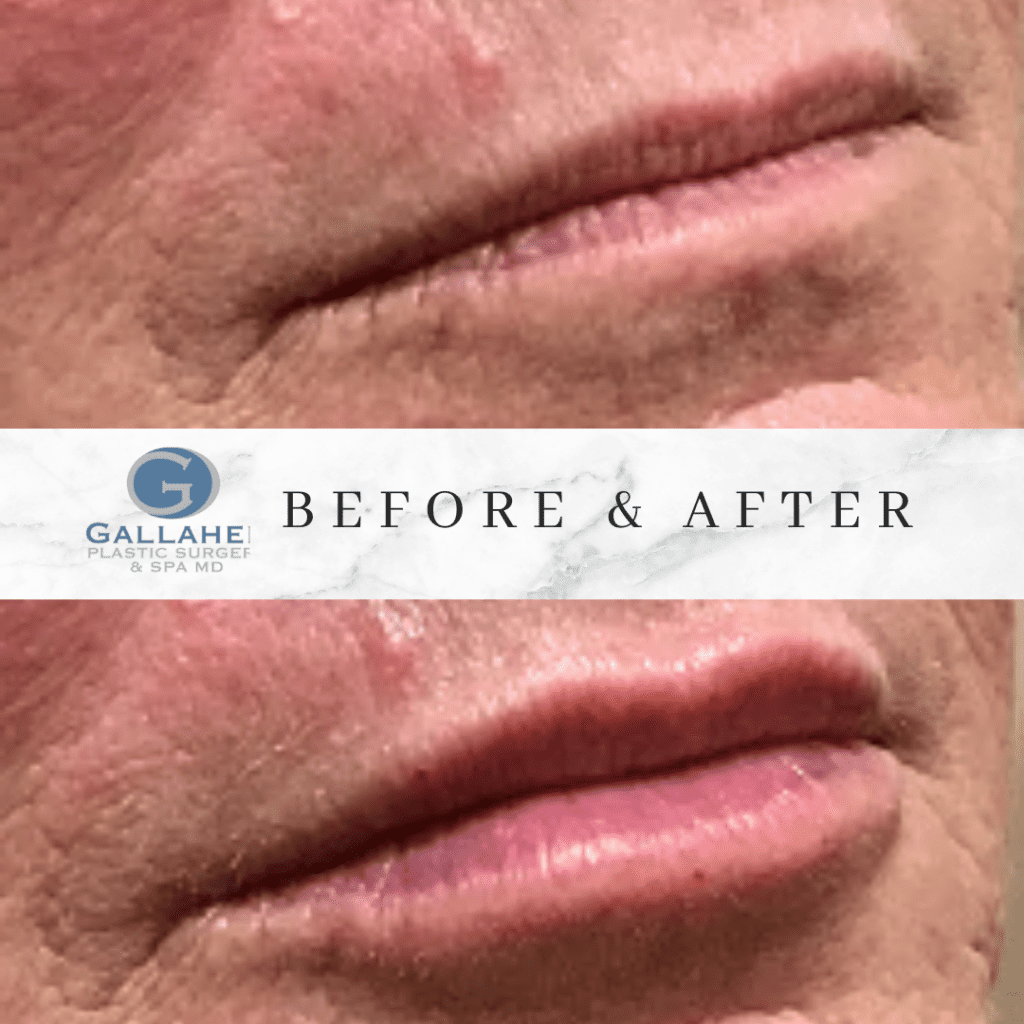 Juvéderm® in Knoxville, Tennessee | Gallaher Plastic Surgery & Spa MD