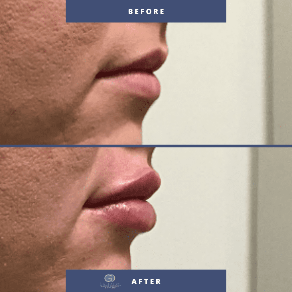 Juvéderm® in Knoxville, Tennessee | Gallaher Plastic Surgery & Spa MD