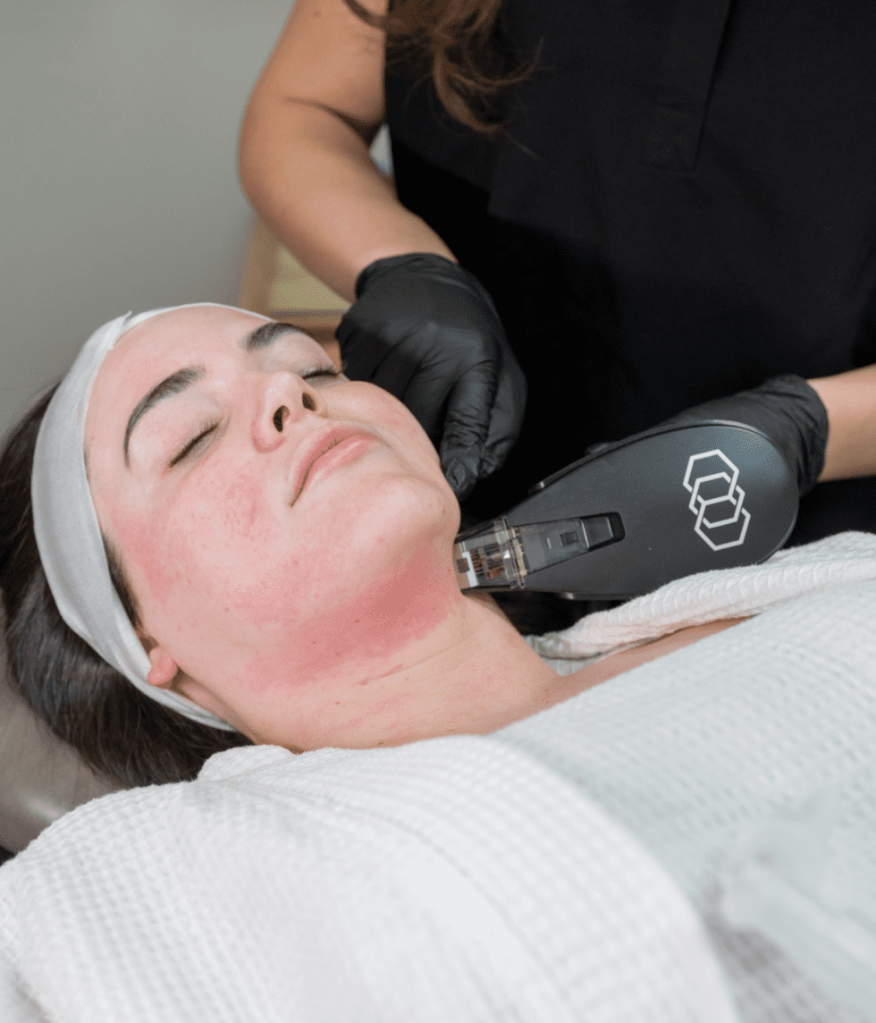Morpheus8 Knoxville, TN | Microneedling | Gallaher Plastic Surgery & Spa MD